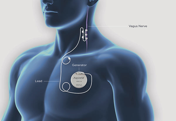 Vagus nerve stimulation (VNS) therapy - Epilepsy Action