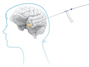 NHS launches laser beam brain surgery - Epilepsy Action