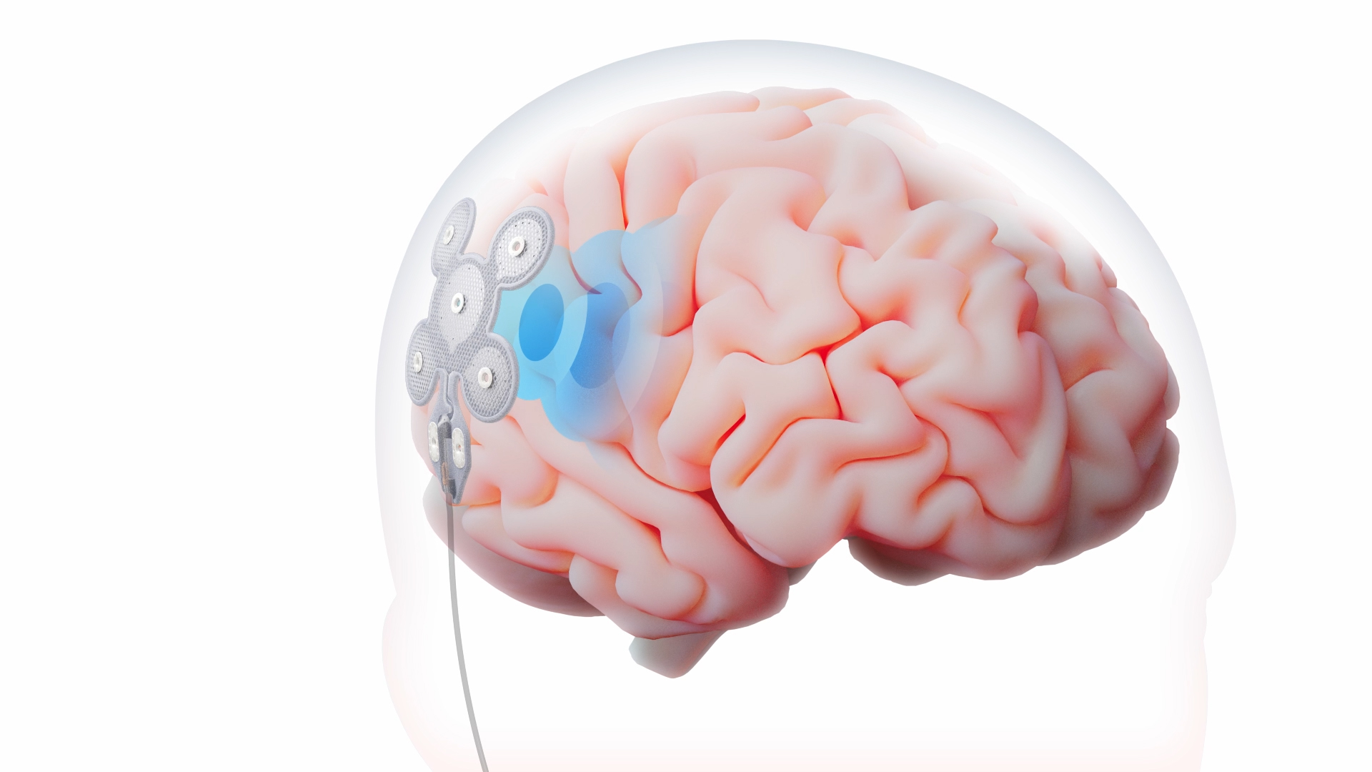New device for drug-resistant focal epilepsy available on NHS ...