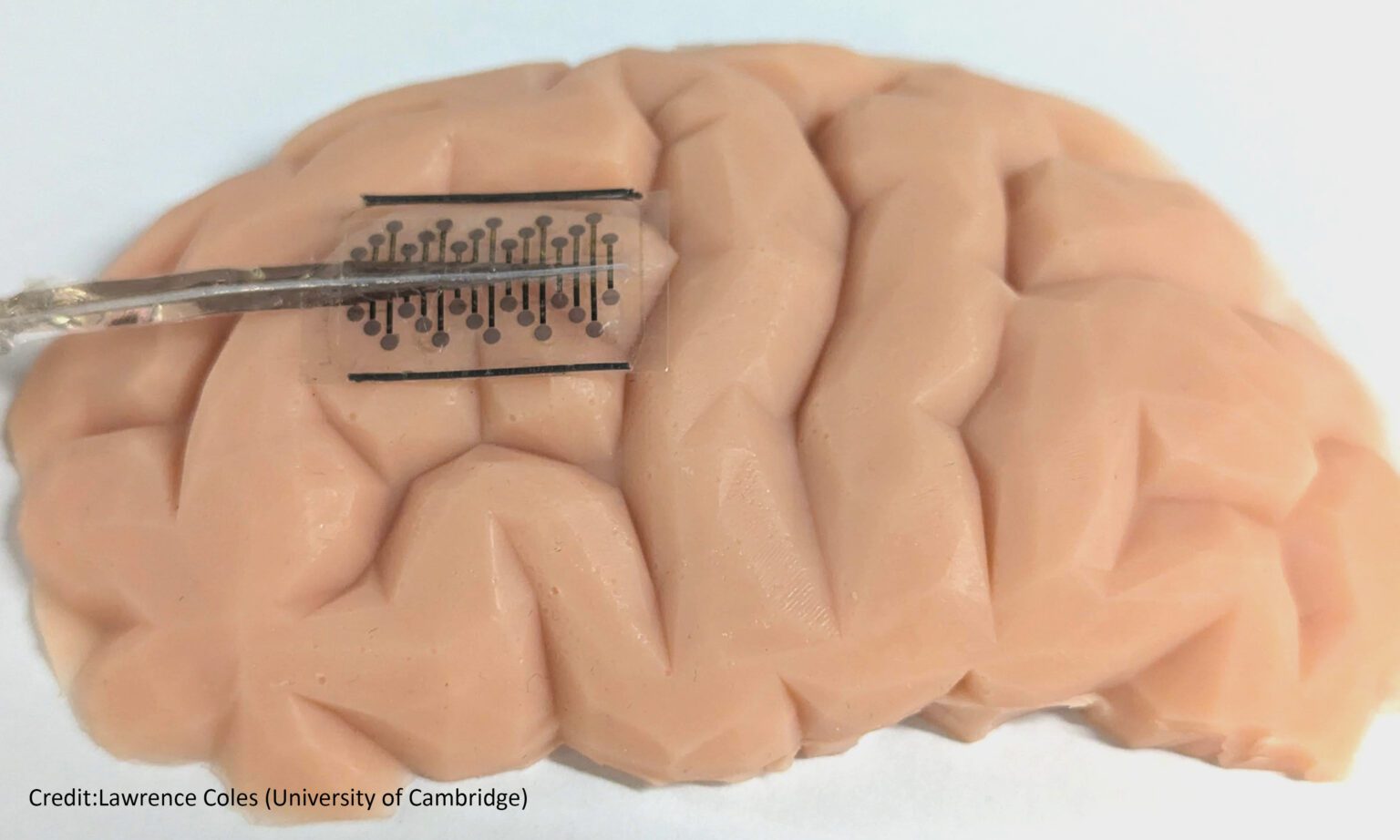 Tiny folding implants improve epilepsy surgery and diagnosis - Epilepsy ...